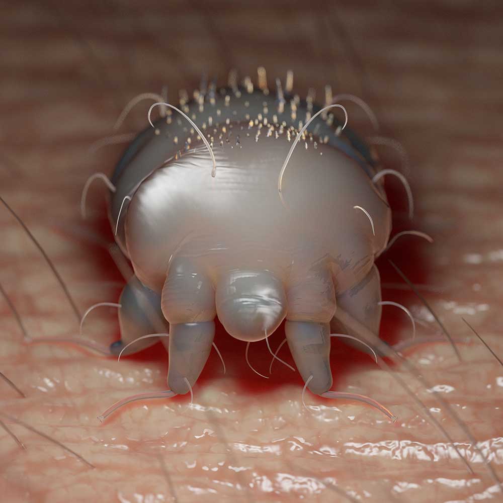 Krätze: hochansteckende Hautinfektion mit Milben